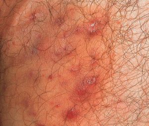 Tinea Inguinalis: Ursachen, Symptome, Verlauf, Diagnose, Therapie